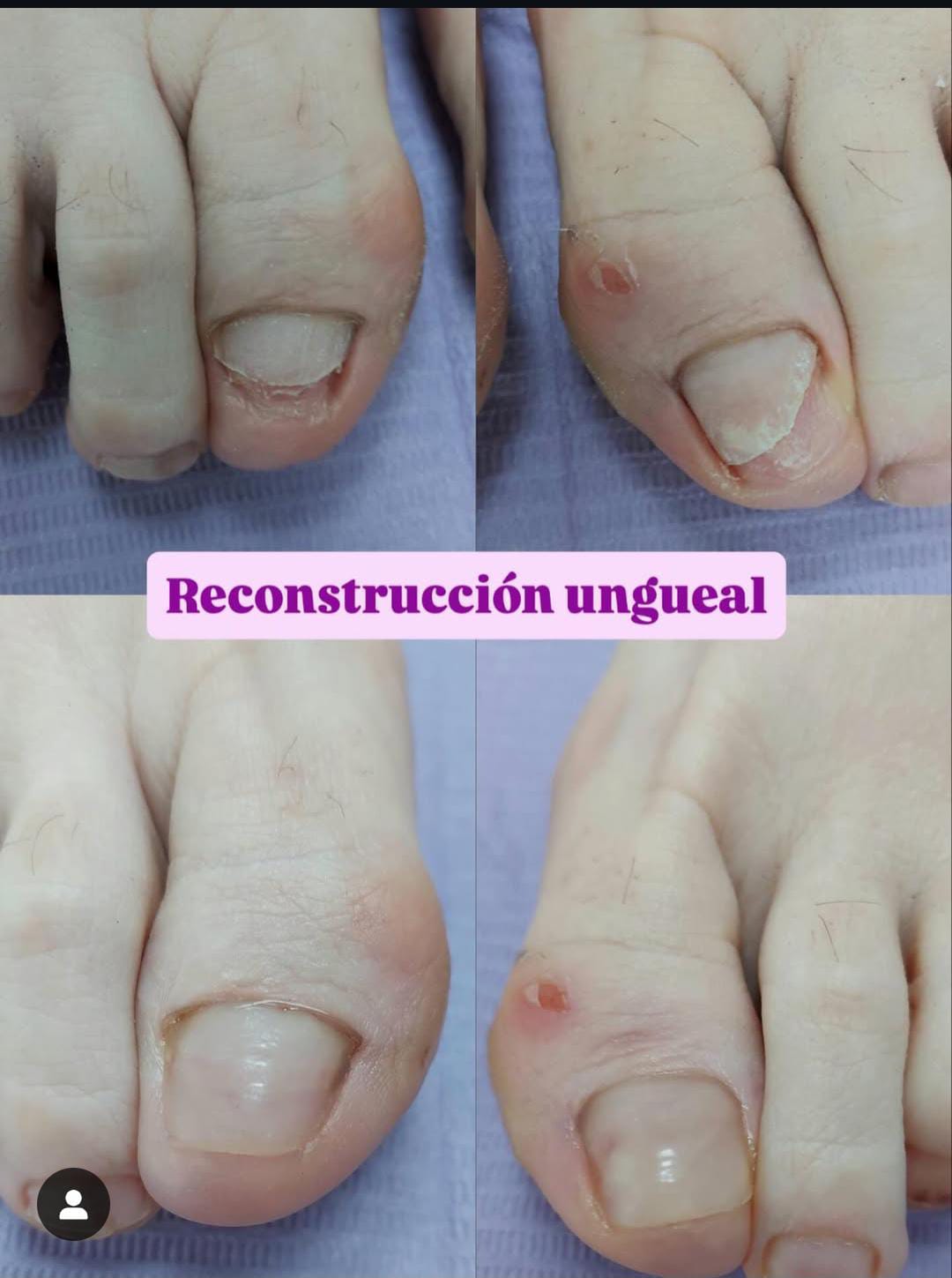 Onicoplastia o Reconstrucción de uña con composite – Podowebinar